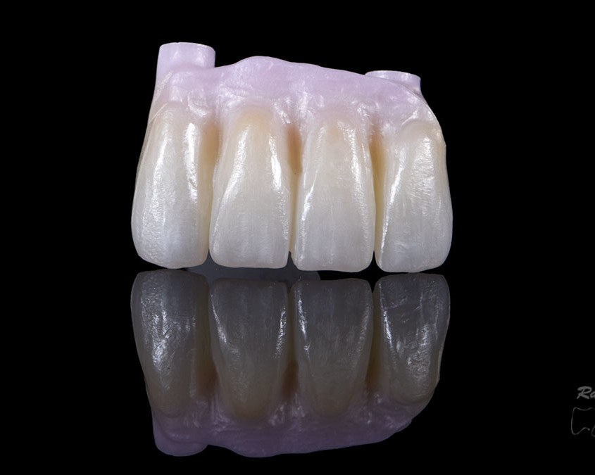 Implants - Crystal Dental Design