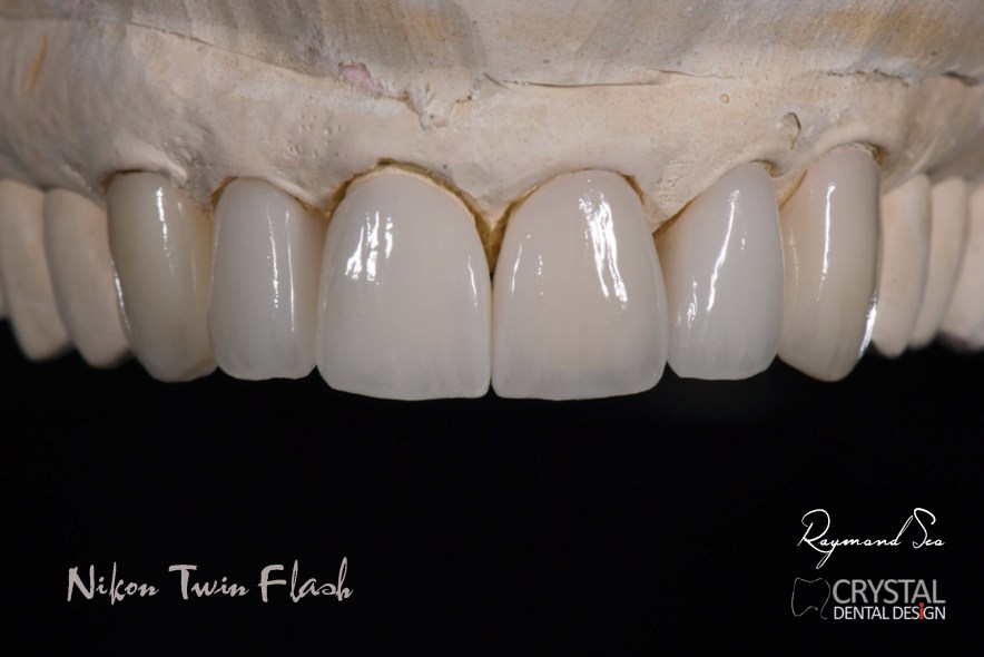 emax2-2 - Crystal Dental Design