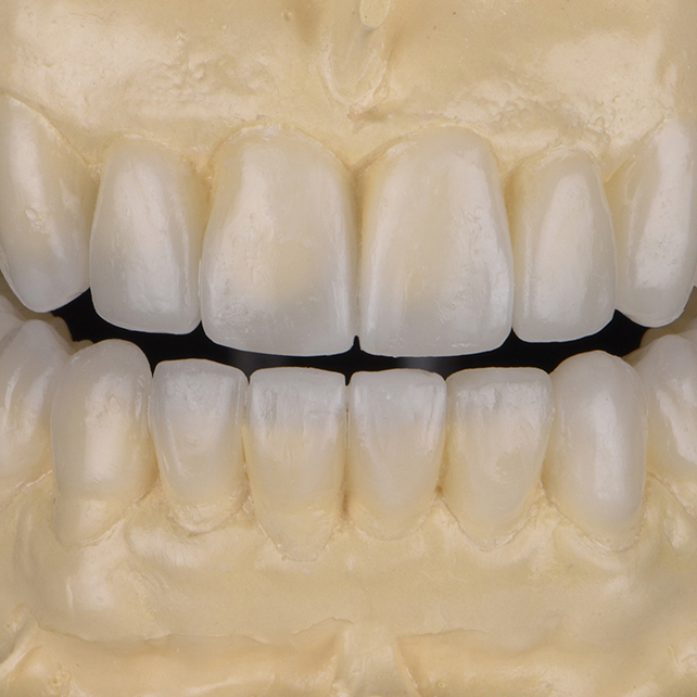 wax2 copy - Crystal Dental Design